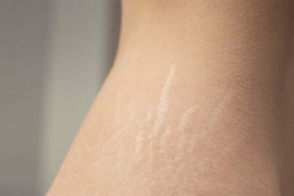 Vergeture de croissance à l'adolescence : causes & solutions - Cellublue