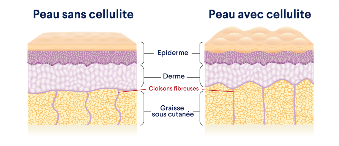 Cellulite : causes, traitements et solutions anti-cellulite - Cellublue