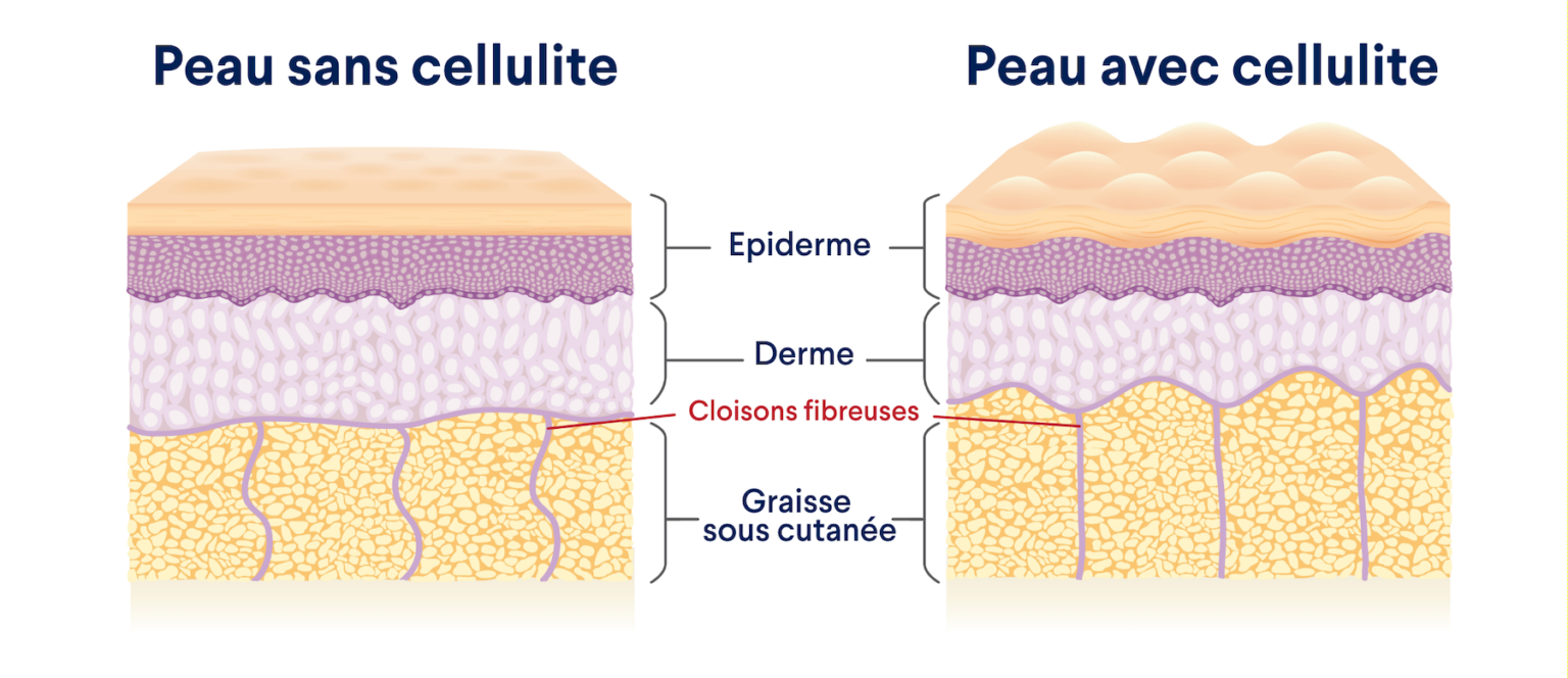 Cellulite : causes, traitements et solutions anti-cellulite - Cellublue
