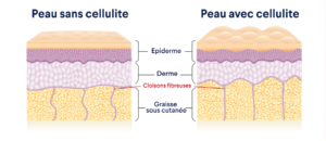 Cellulite : causes, traitements et solutions anti-cellulite - Cellublue